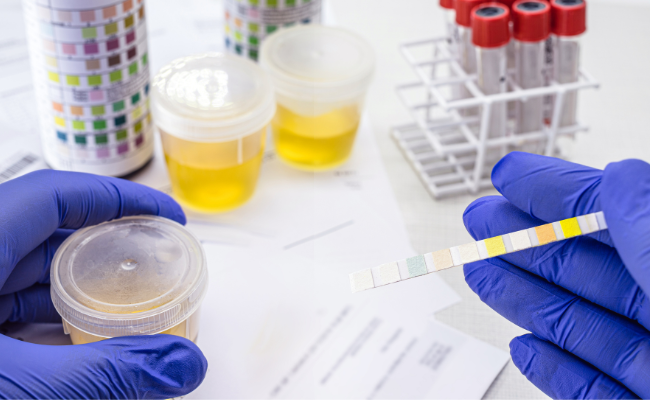 Elevated Urobilinogen: Causes and Solutions for Urinary Conc