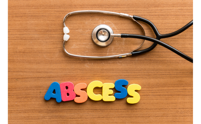 Fast Relief for Inner Thigh Abscess: Expert Tips