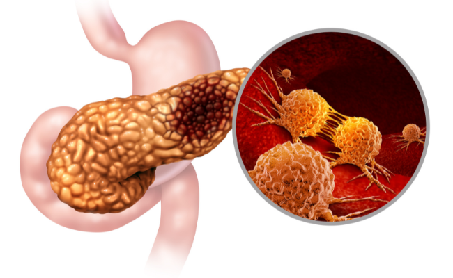 Resolve Pancreatic Cancer Edema Now! Expert Guidance