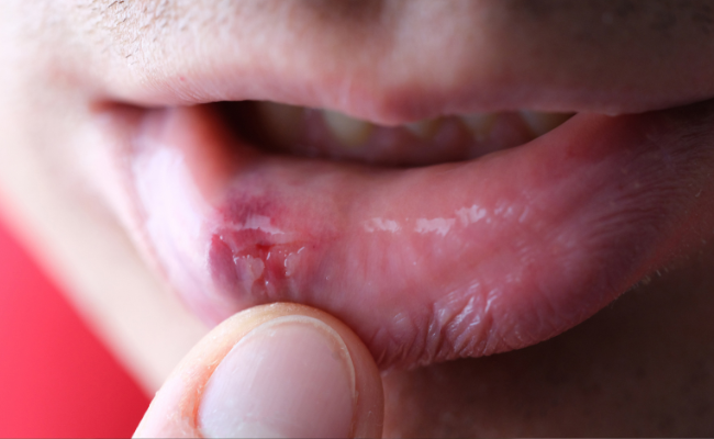 Bump on Inner Lip: Causes and When to Consult a Doctor