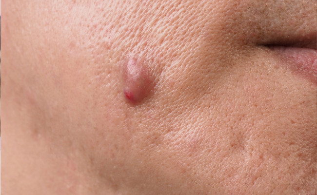 Persistent Lump on Face: Causes and When to See a Doctor
