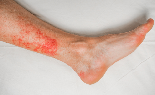 Swollen Leg and Rash After a Cut? Consult Our Experts Today!