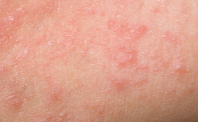 Worried About Skin Scabs? Get Expert Advice and Treatment