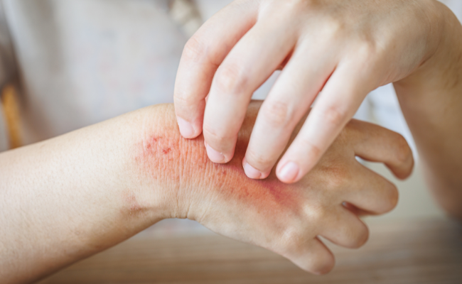 Rash After Amoxicillin? Get Expert Advice & Immediate Help