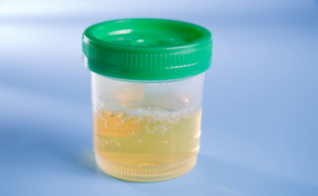 Blood in Stool or Foamy Urine? Get Expert Advice Today