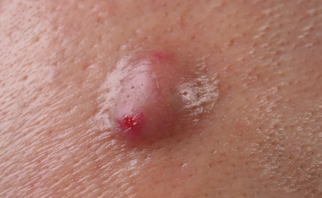 Swollen Bump & Bleeding – Should You Be Worried?