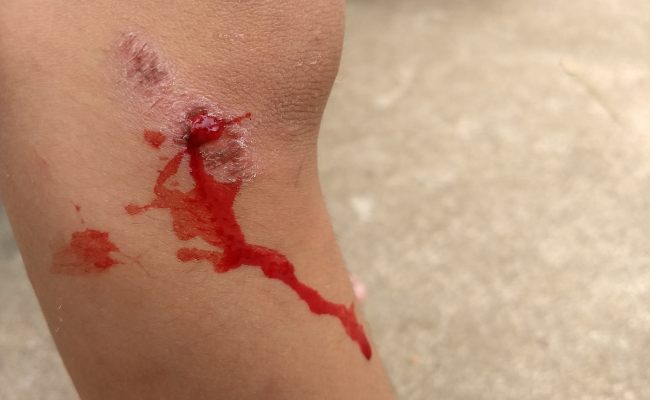Is It Normal to Have Bleeding Under the Skin?